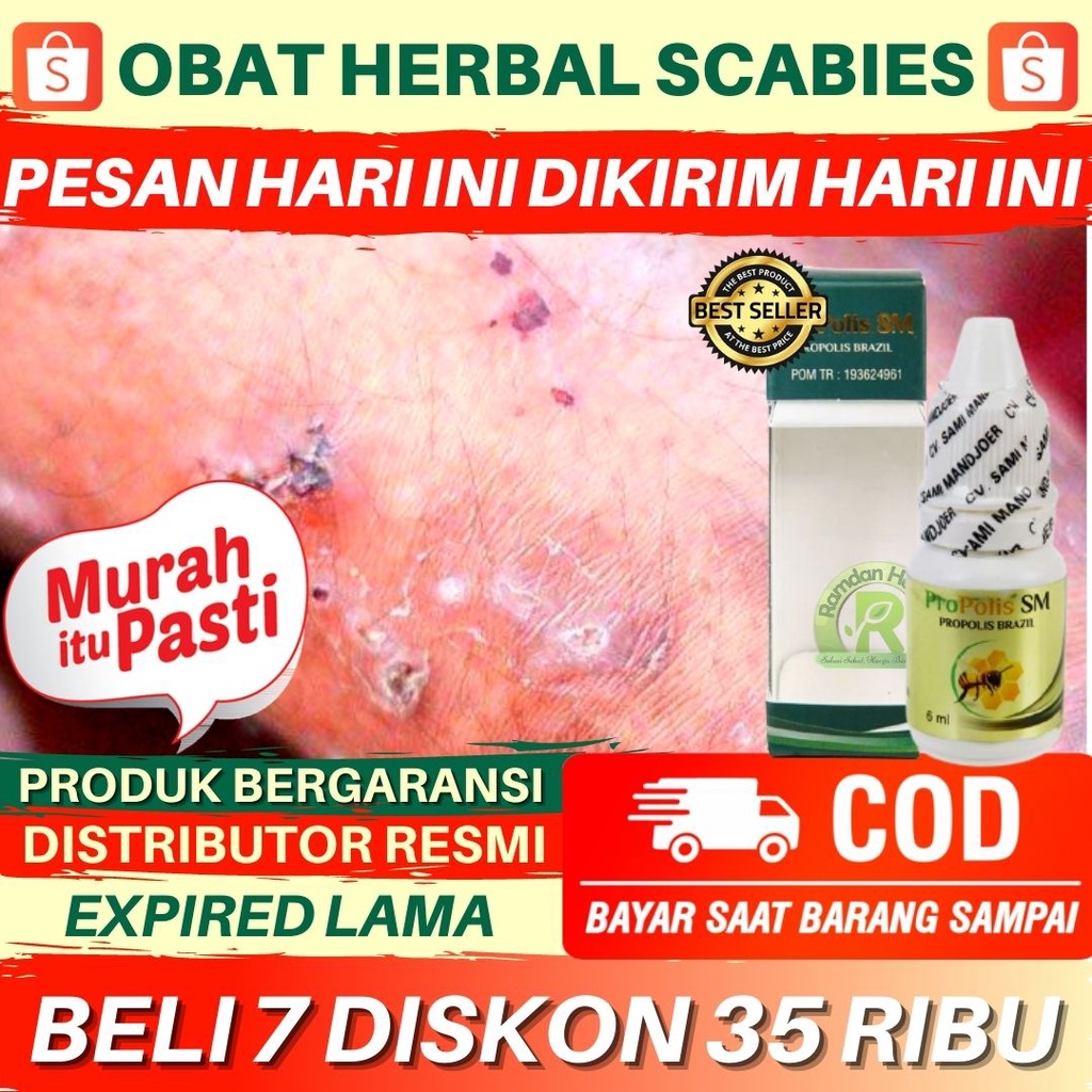 Jual Obat Scabies Di Apotik, Scabies Manusia, Gatel Gatal Alergi, Obat ...