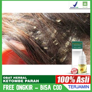 Jual Obat ketombe Berkerak, Borok, Akut, Ketombe Rambut, Ketombe Kulit Kepala Kering Propolis SM ...