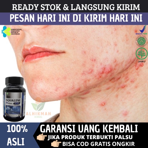 Jual Obat Alergi Kulit Bintik Bintik Merah Di Wajah, Obat Alergi ...