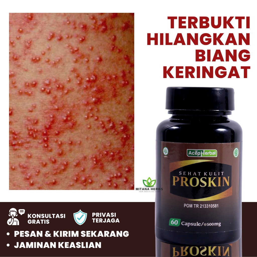 Jual Mitana Herbal - Obat Biang Keringat Dewasa - Obat Biang Keringat ...