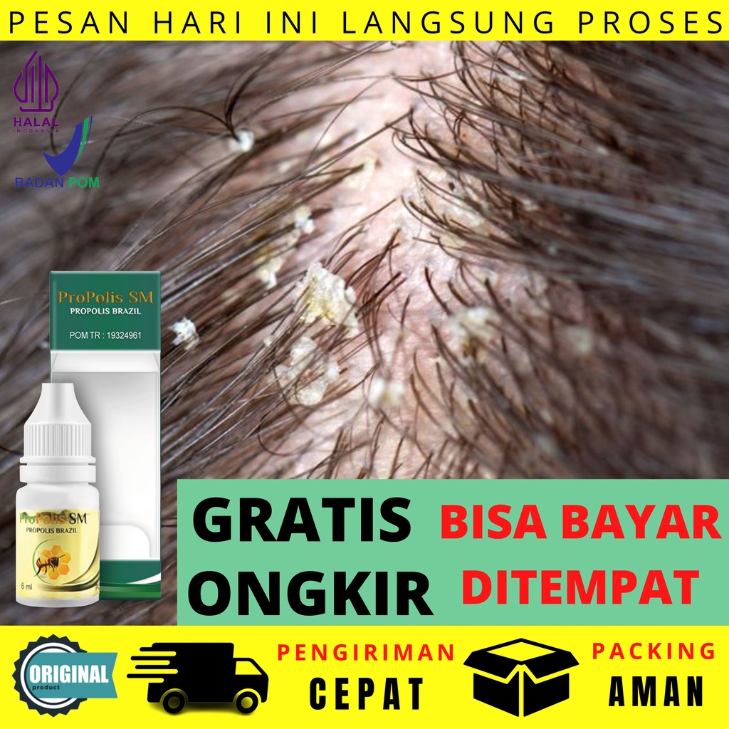 Jual Obat Ketombe Berkerak Kerak Di Kulit Kepala Dermatitis Seboroik Herbal Dermatitis Seboroik ...