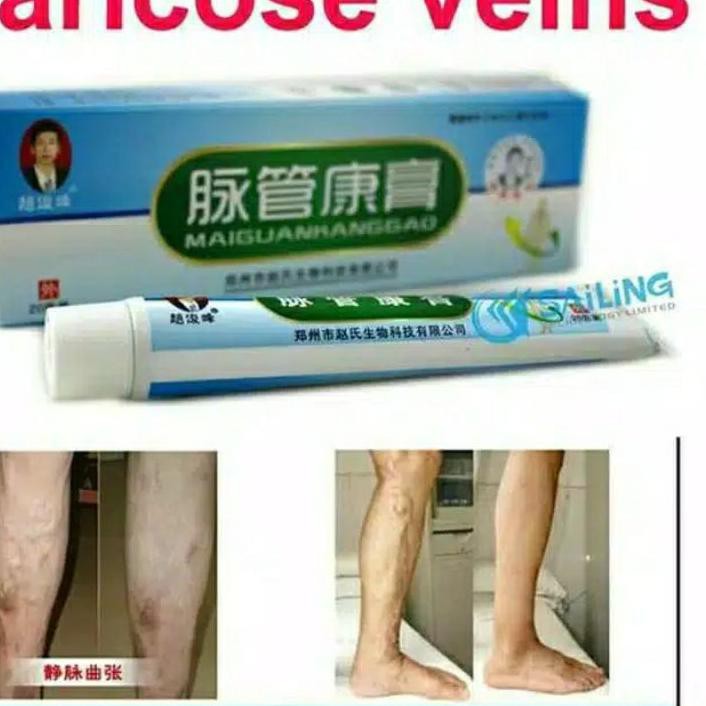 Jual Terbaru - Krim Salep China Untuk Pengobatan Varises kaki ...