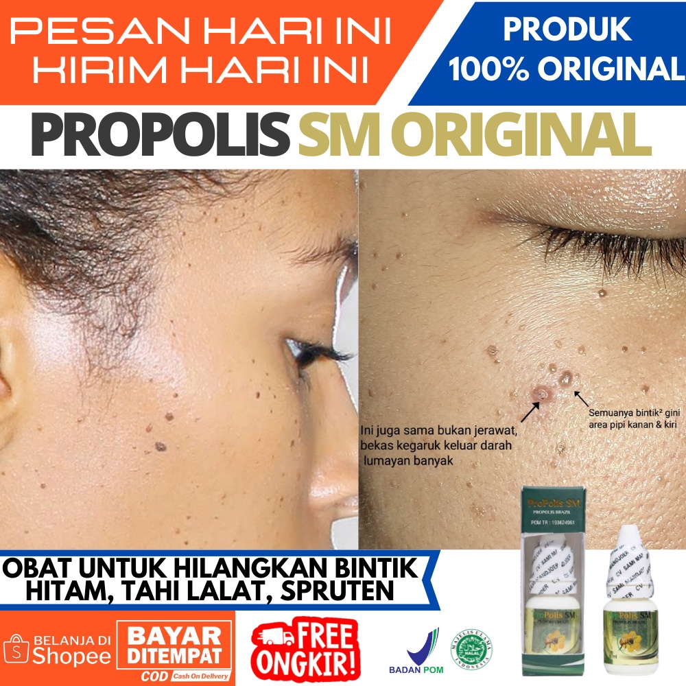 Jual Obat Menghilangkan Bintik Hitam di Wajah Seperti Tahi Lalat ... Jual Obat Menghilangkan Bintik Hitam di Wajah Seperti Tahi Lalat ...
