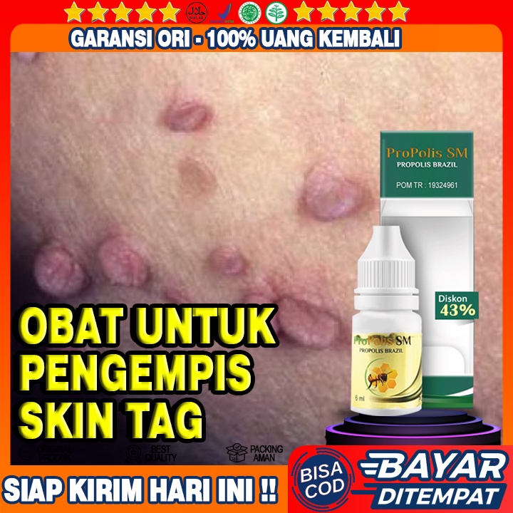 Jual Obat Skin Tag, Obat Penghilang Skin Tag, Obat Oles Perontok Kutil ...