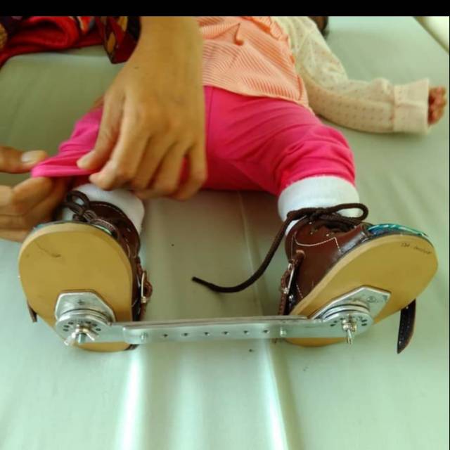 Sepatu Ctev / kaki pengkor / dennis brown Splint / sepatu ortopedi ...