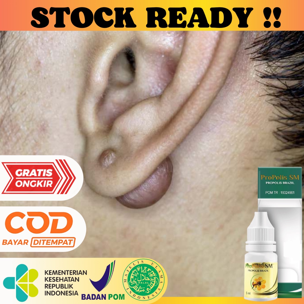 Jual Obat Tetes Oles Penghilang Benjolan Di Daun Telinga - Obat ...