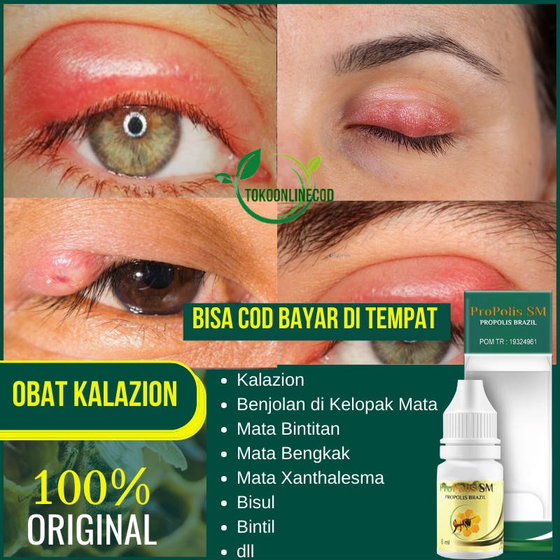 Jual Obat Benjolan di Kelopak Mata, Kalazion, Mata Bengkak, Mata Bintit ...