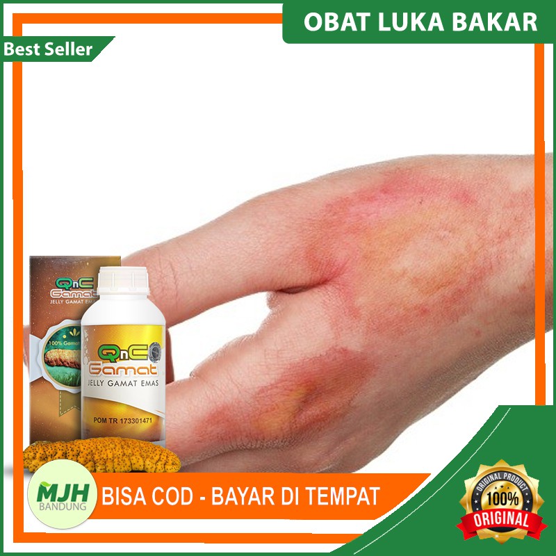 Jual Salep Obat Luka Bakar - Luka Bernanah - Luka Berair - Luka Basah ...