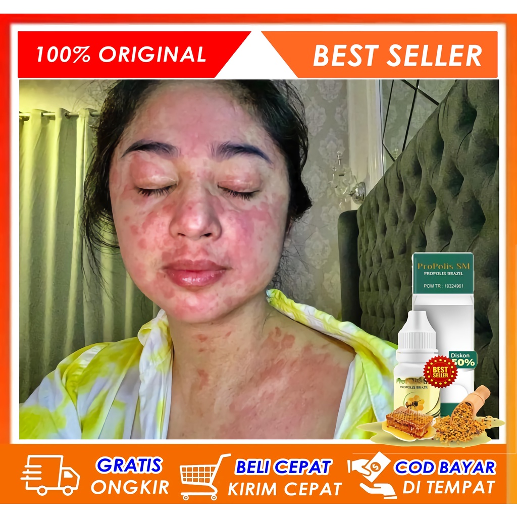 Jual Obat Ruam Merah, Penghilang Ruam Kulit Merah di Badan, Kaki ...