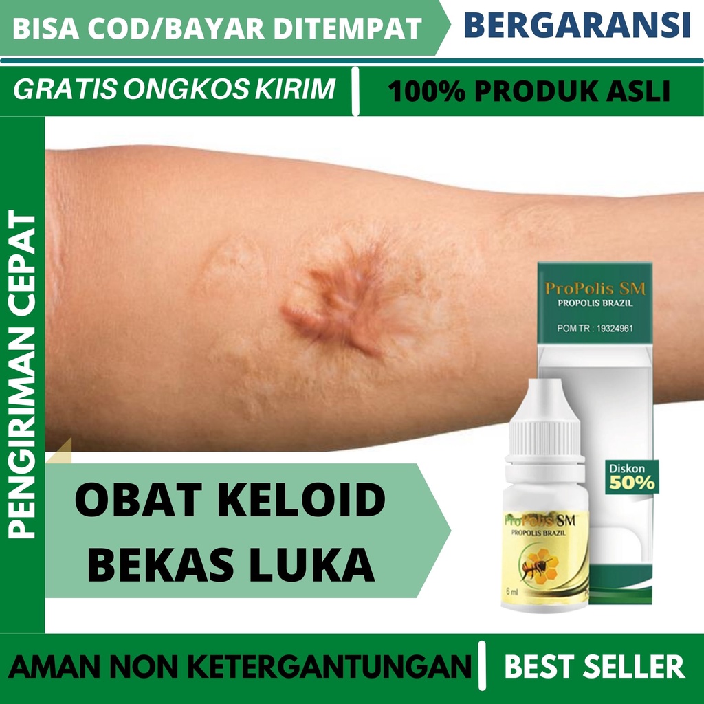 Jual Obat keloid bekas luka, Keloid luka bakar, Bekas jatuh, Bekas ...