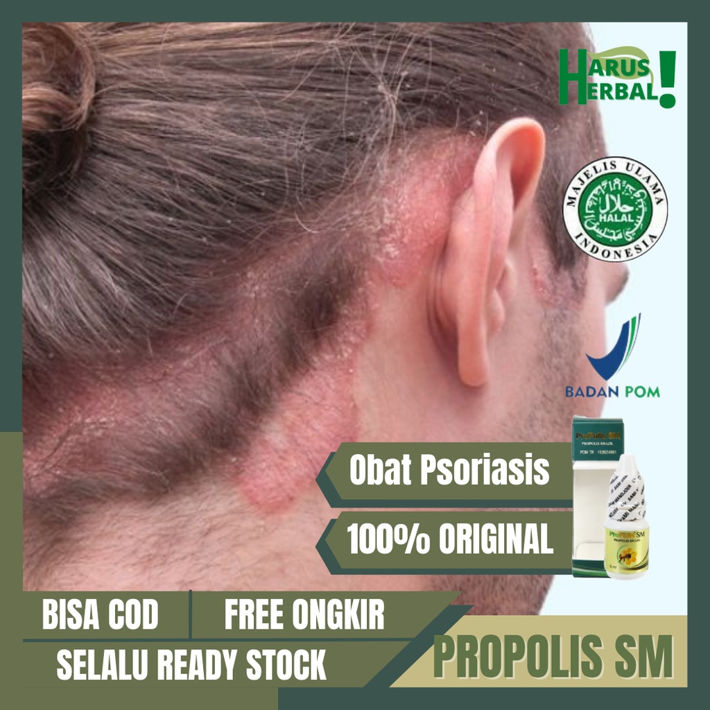 Jual Obat Psoriasis Kulit Kepala, Kulit Kepala Kering Berkerak, Obat Kulit Kepala Bersisik ...