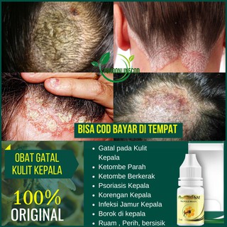 Jual Obat Gatal Kulit Kepala, Ketombe Rambut Kerak, Kulit Kering Bersisik, Koreng Berjamur ...