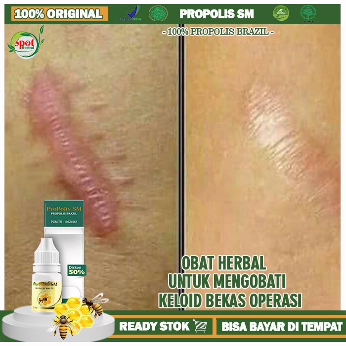 Jual Obat Bekas Luka Operasi Keloid, Obat Penghilang Bekas Luka Lama ...