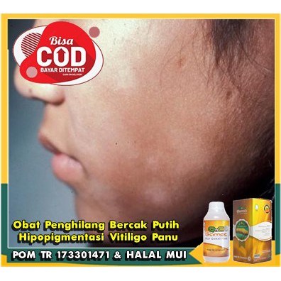 Jual Obat Penghilang Bercak Putih di Tubuh Wajah Tangan Kaki ...