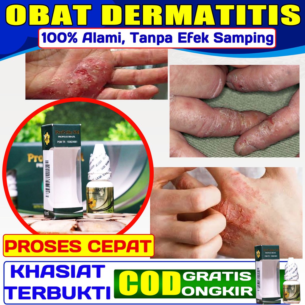 Jual Obat Dermatitis, Kulit Kering / Berair, Perih & Luka, Ruam Kulit ...
