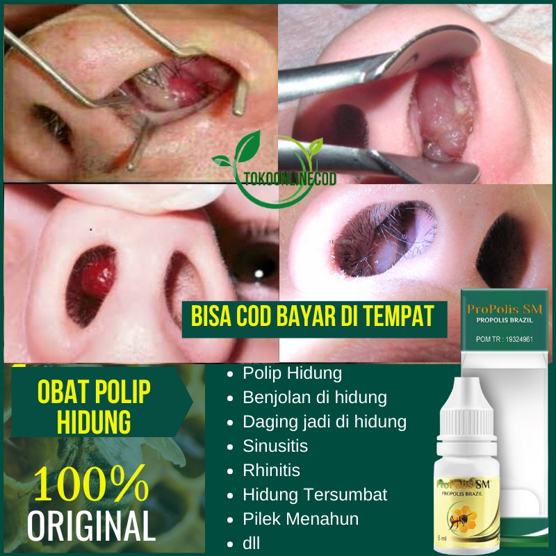 Jual Obat Tetes Polip Hidung Penghilang Benjolan Dihidung Daging