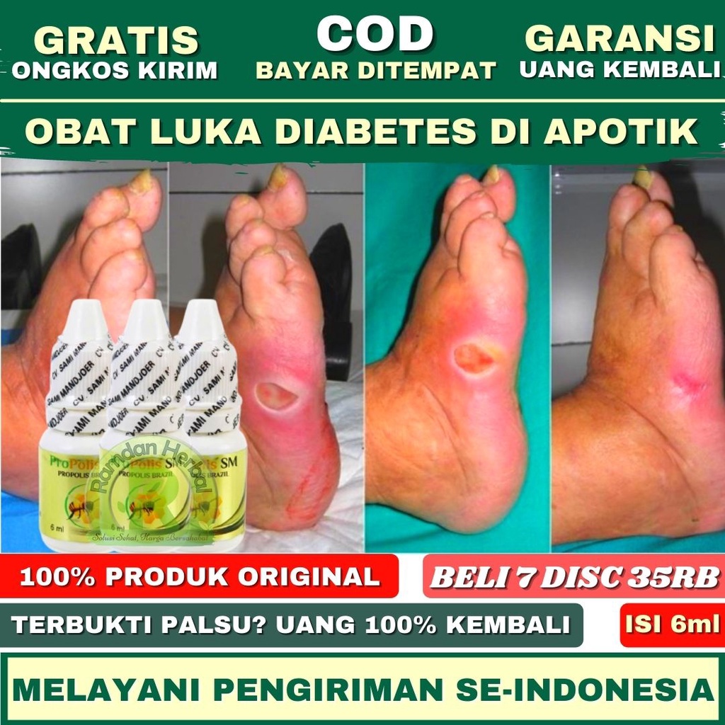 Jual Obat Luka Diabetes Di Apotik - Pengering Luka - Gejala Diabetes ...