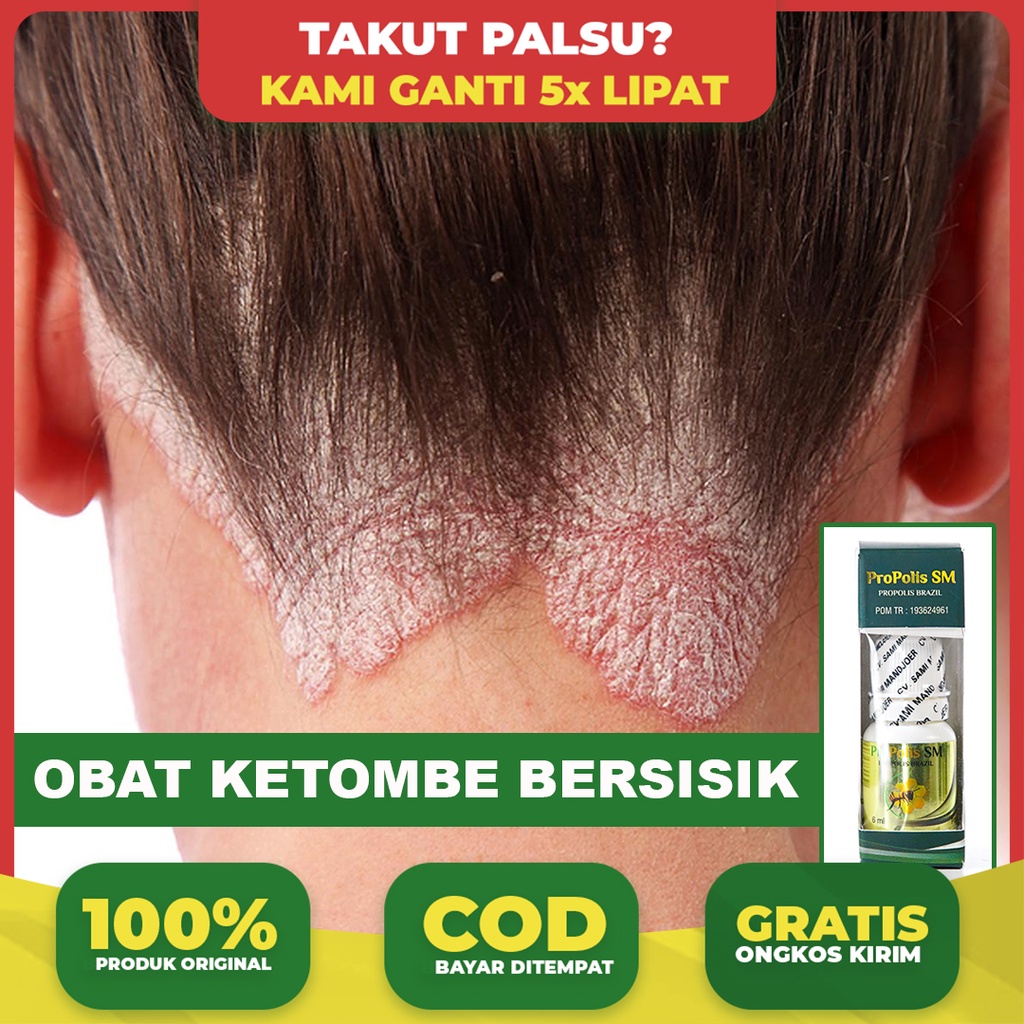 Jual Obat Ketombe Bersisik, Kulit kepala berkerak, Ketombe Gatal Parah - PROPOLIS SM 100% ASLI ...