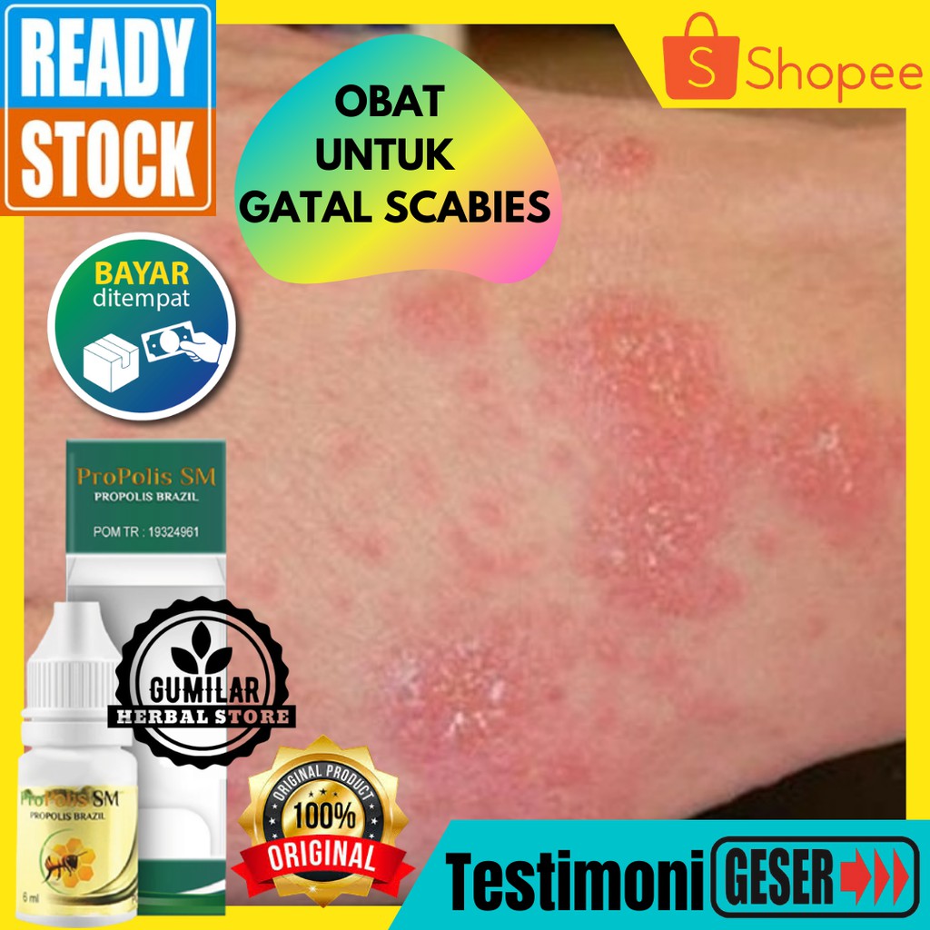 Jual OBAT TETES GATAL SCABIES PADA MANUSIA - OBAT SCABIES GATAL GUDIK ...