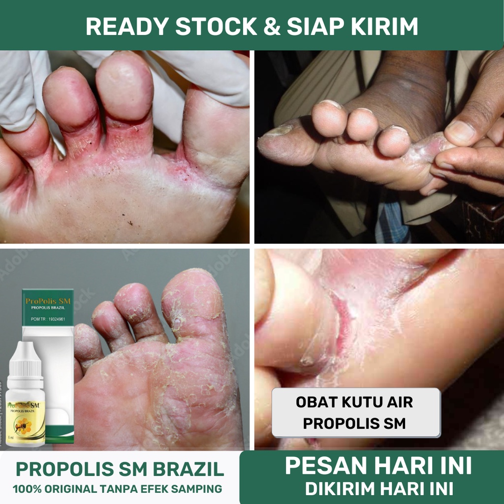 Jual Obat Kutu Air Di Jari Tangan Dan Kaki, Obat Penghilang Kutu Air ... Jual Obat Kutu Air Di Jari Tangan Dan Kaki, Obat Penghilang Kutu Air ...