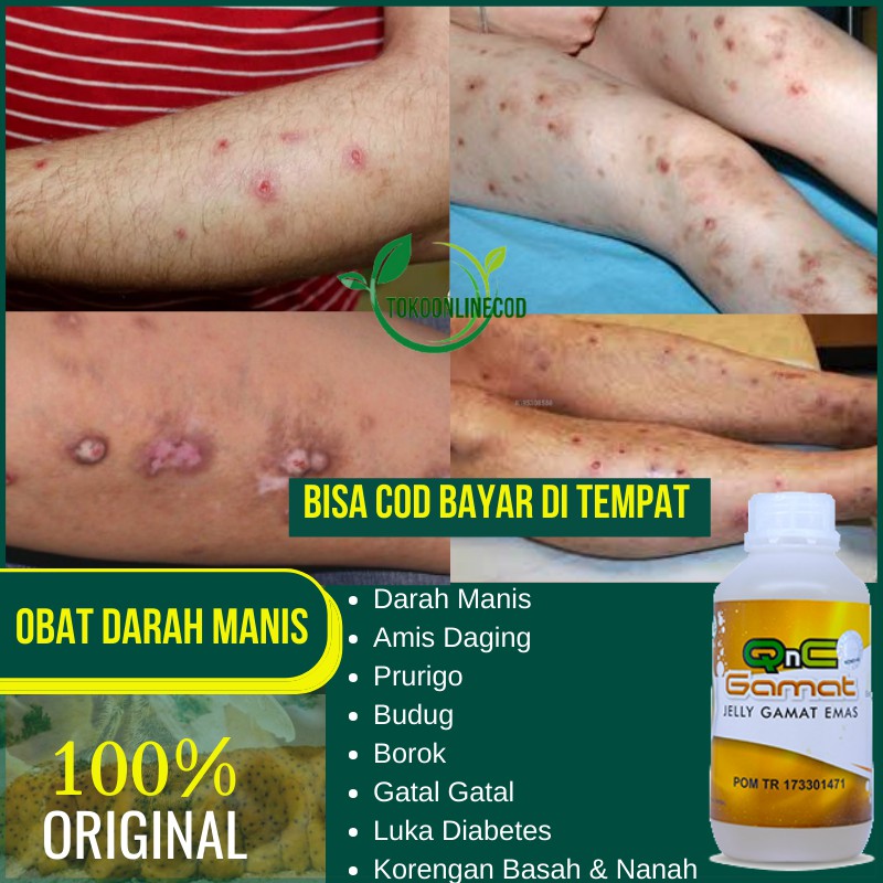 Jual Obat Darah Manis, Prurigo, Amis Daging, Koreng di Kaki, Budug ...
