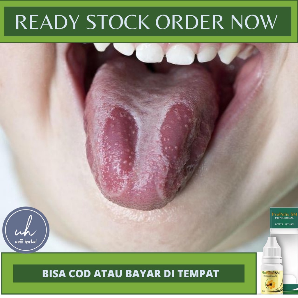 Jual OBAT CANDIDIASIS - 100 % ORIGINAL SUDAH BPOM & HALAL MUI - OBAT HERBAL CANDIDIASIS PADA ...