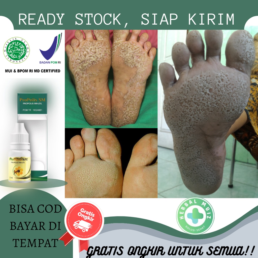 Jual Obat Salep Oles Untuk Telapak Kaki Gatal Rayapan dan Bau / Obat ...