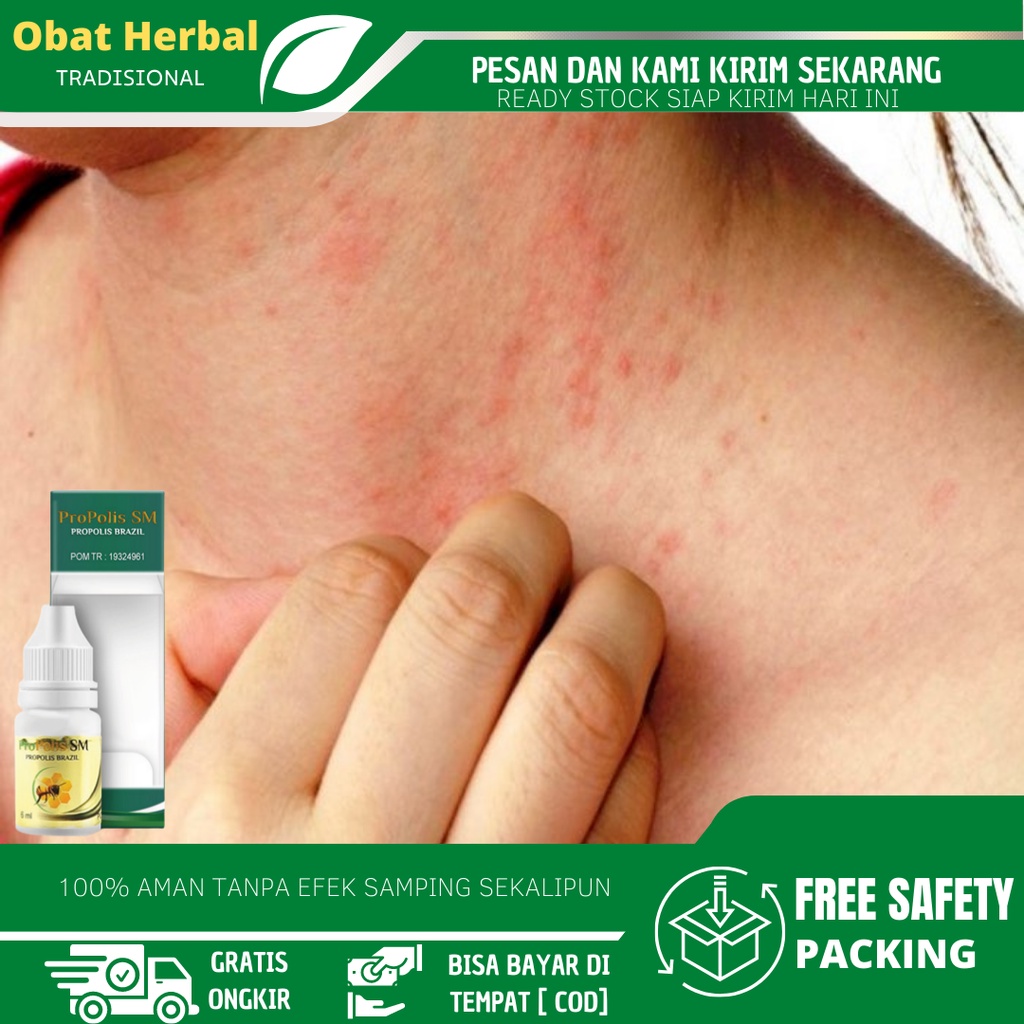 Jual Obat Biang Keringat, Obat Bruntusan Gatal, Ruam Merah Pada Bayi ...