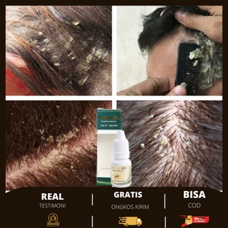 Jual Obat Penghilang Ketombe Berkerak, Obat Ketombe Rambut Rontok Berkerak, Obat Penghilang ...