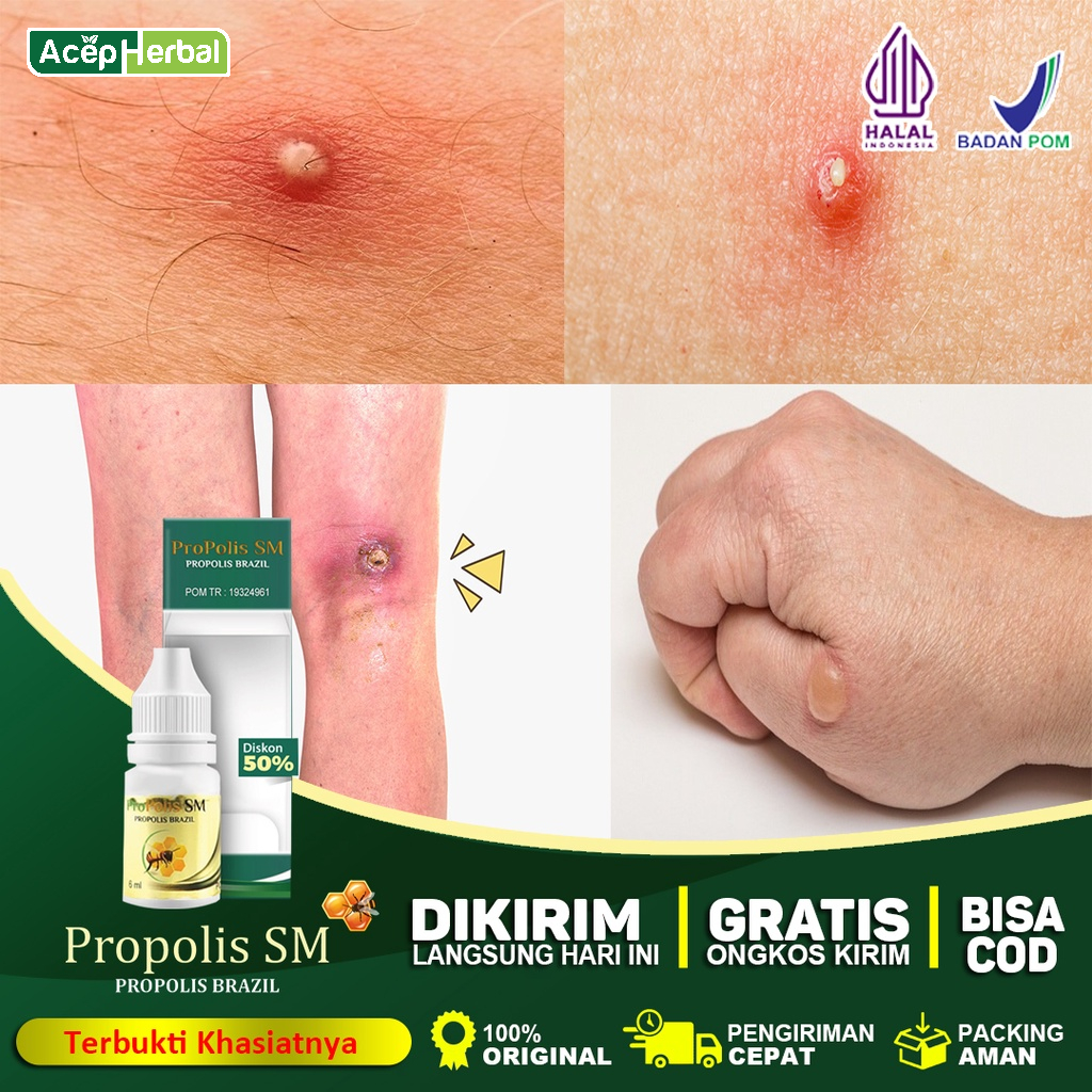 Jual Obat Bisul Bernanah Bisul Bengkak Bisul Pecah Berdarah Obat Tetes ... Jual Obat Bisul Bernanah Bisul Bengkak Bisul Pecah Berdarah Obat Tetes ...