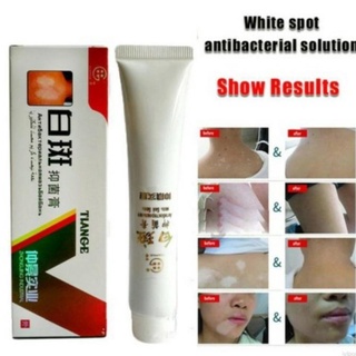 Jual Obat Salep Vitiligo Tiange Cream Psolaren Penyakit Kulit Belang Putih | Shopee Indonesia