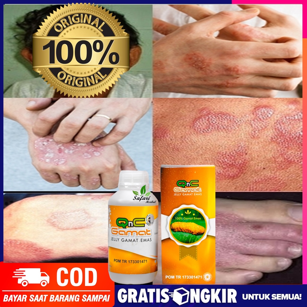 Jual Obat Kusta - Lepra - Kusta Kering - Kusta Basah - Obat Penyakit ...