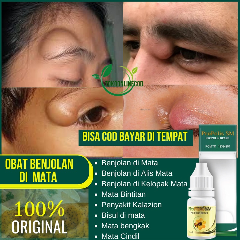 Jual Obat Benjolan di Mata, Penghilang Benjolan di Alis Mata, Pengempes ...