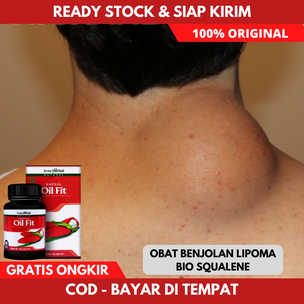 Jual Obat Benjolan Lipoma, Obat Benjolan Lemak, Tiroid, Kelenjar Getah ... Jual Obat Benjolan Lipoma, Obat Benjolan Lemak, Tiroid, Kelenjar Getah ...
