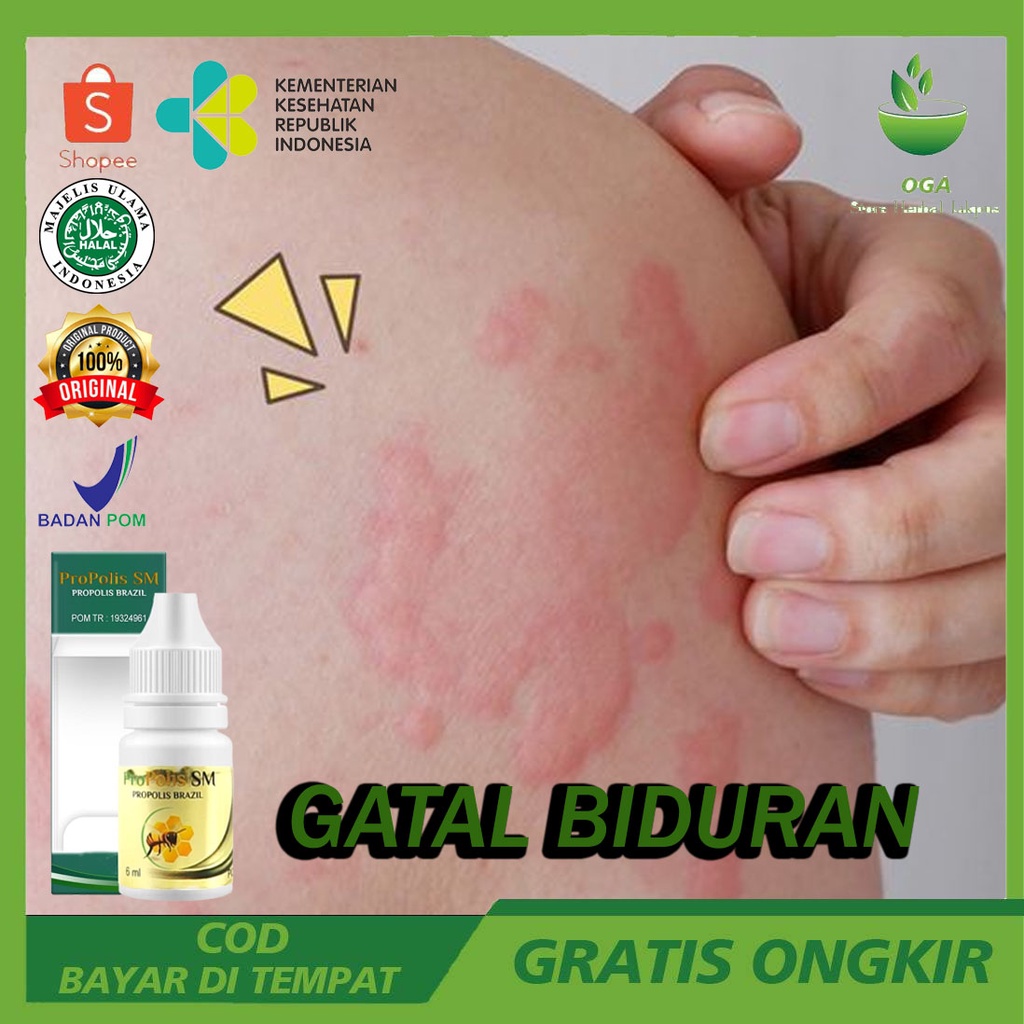 Jual Obat Biduren Herbal Obat Gatal Bekas Biduran, Alergi Penyakti ...