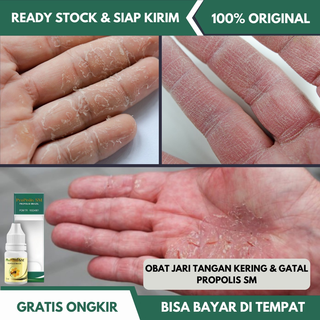 Jual Obat Jari Tangan Kering, Obat Telapak Tangan Kasar, Obat Tangan ...