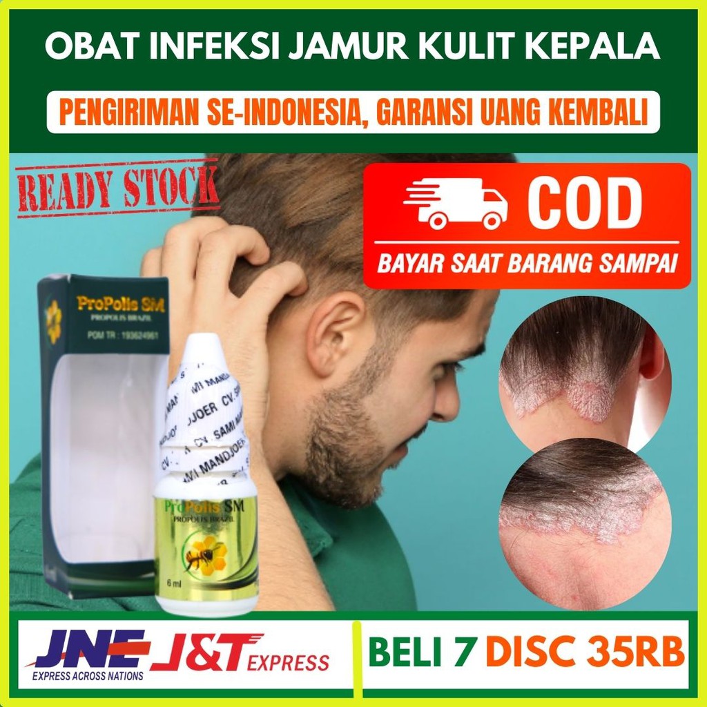 Jual Obat Infeksi Jamur Kulit Kepala-Kulit Kepala Gatal Hebat-Borok-Tinea Capitis-Propolis SM ...