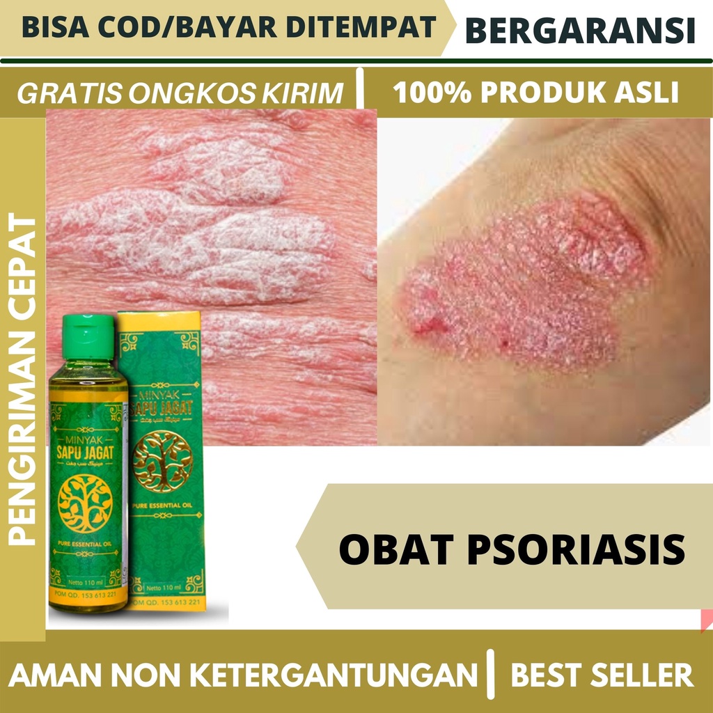 Jual Obat gatal psoriasis, Gatal kulit kering, Kulit bersisik, Kuman ...
