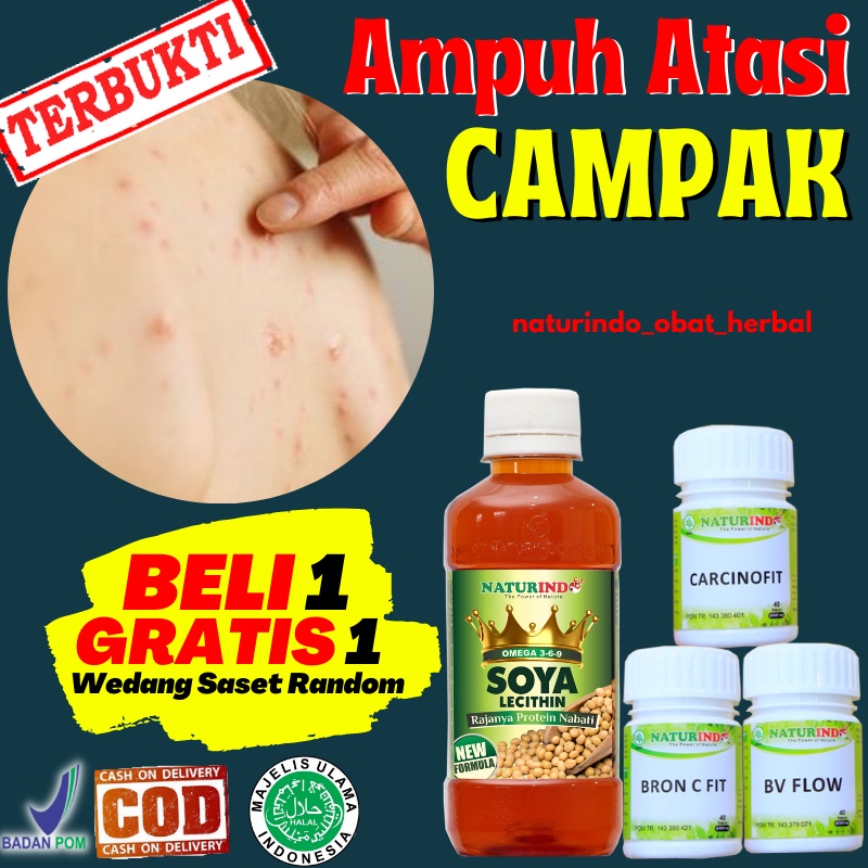 Jual Obat Campak Gabak Rubela Scabies Gudik Gatal Gatel Tampek Skabies ...