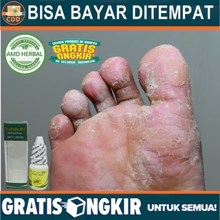 Jual Obat Kutu Air Untuk Kaki, Kutu Air di Tangan, Obat Gatal dan Kutu ...