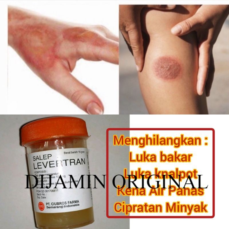 Jual Salep Levertran 15gr/ Salep Luka Bakar paling ampuh | Shopee Indonesia