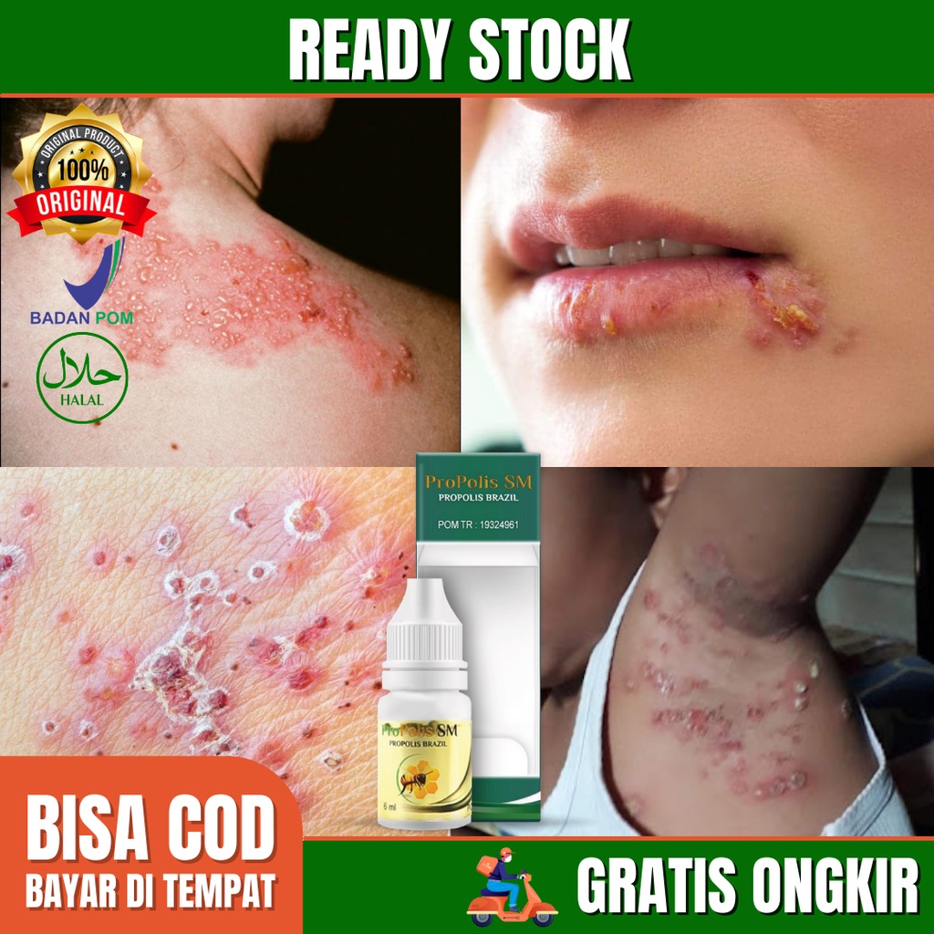Jual Obat Cacar Air - Salep Cacar Air - Obat Kulit Cacar - Obat Cacar ... Jual Obat Cacar Air - Salep Cacar Air - Obat Kulit Cacar - Obat Cacar ...