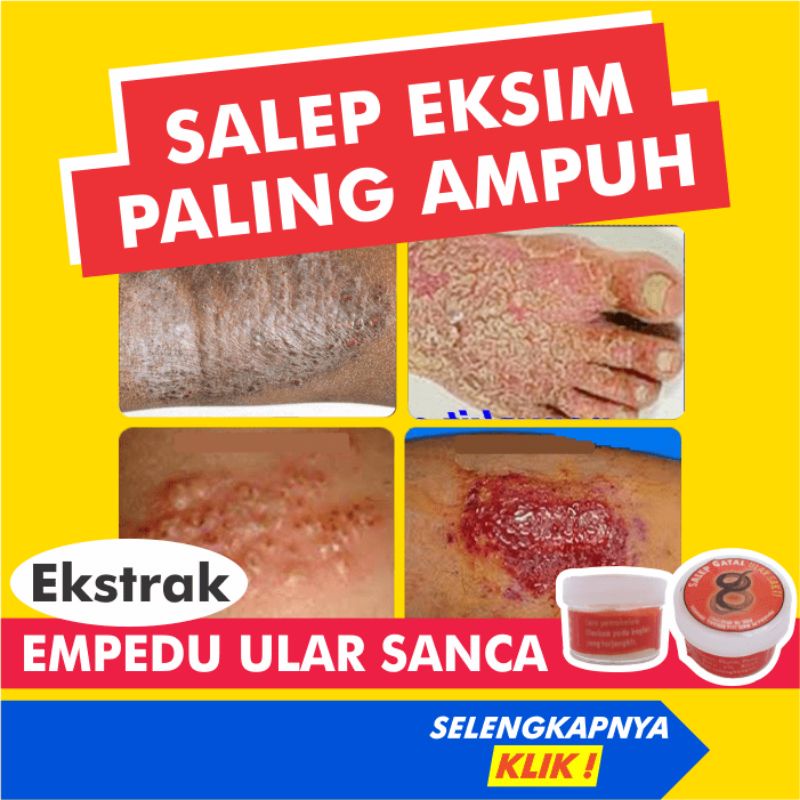 Jual Salep Obat Gatal Eksim Kering Basah Menahun Paling Ampuh Kulit ...