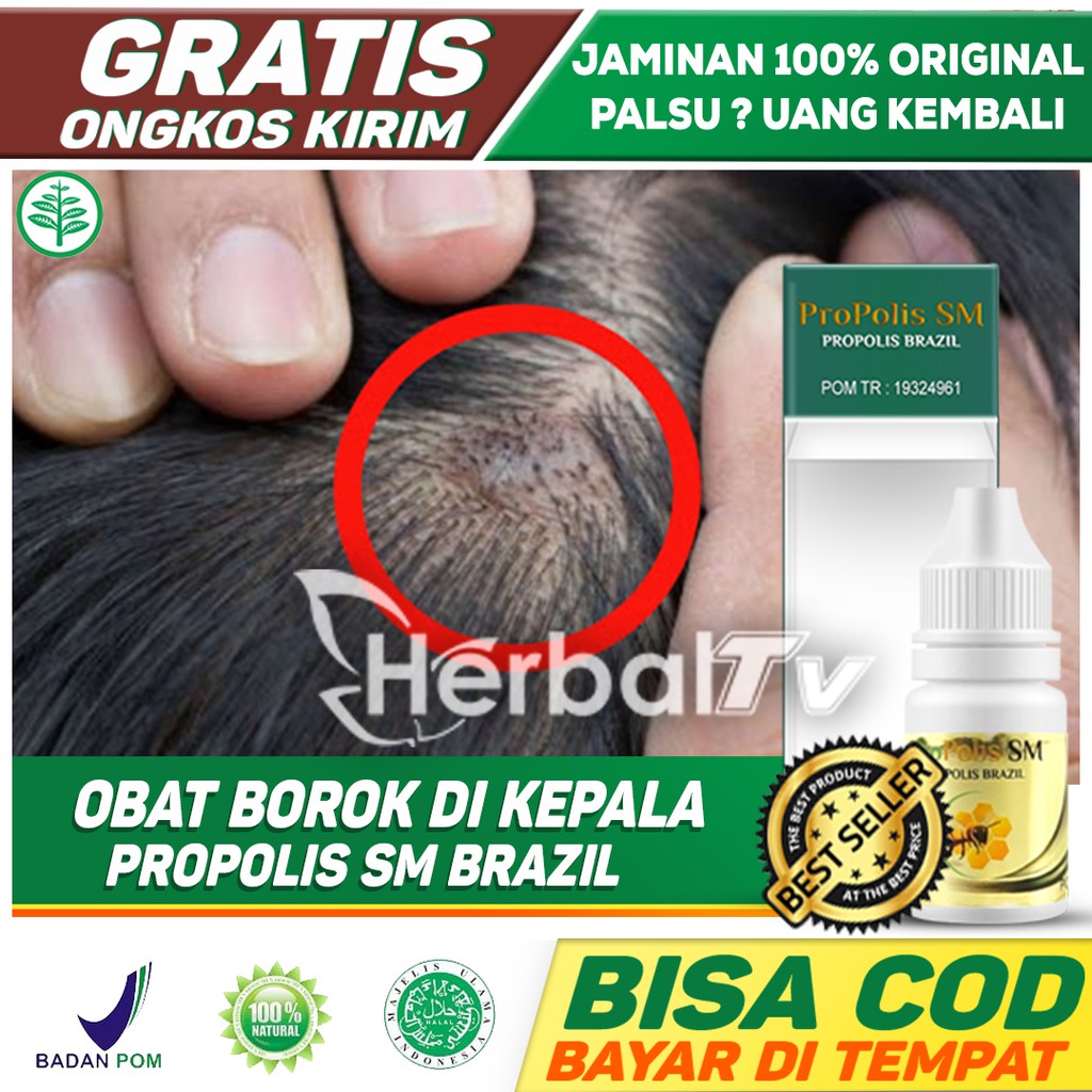Jual Obat Borok Di Kepala, Koreng, Jamur Kulit Kepala Berkerak, Psoriasis, Kulit Bersisik Herbal ...