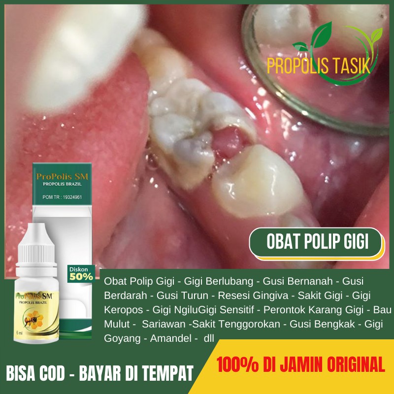 Jual Obat Polip Gigi - Polip Pulpa - Benjolan di Gigi - Daging Tumbuh - Gingiva Pulpitis di Gigi ...