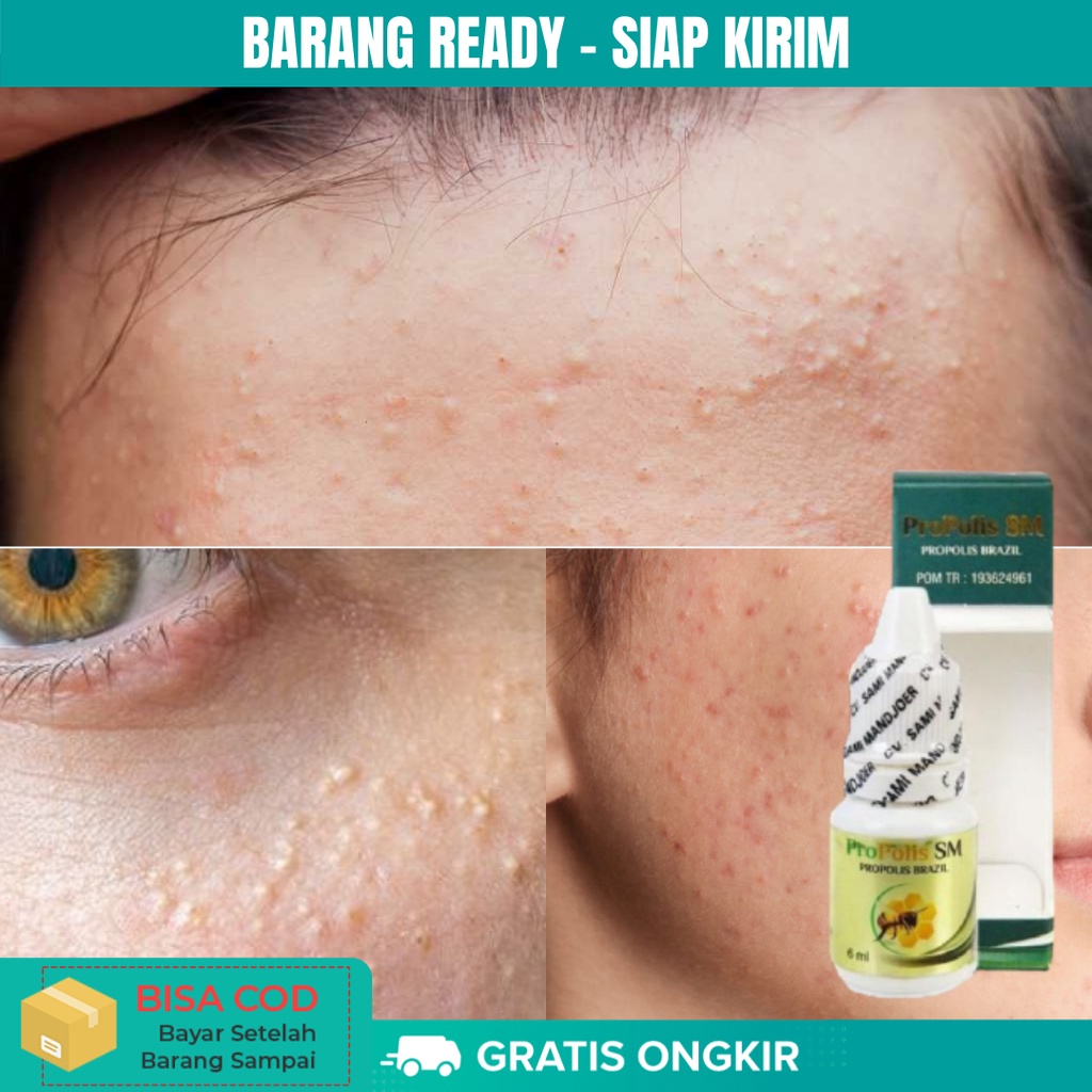 Jual Obat Penghilang Milia Beruntusan di Wajah, Bintik Bintik Putih ...