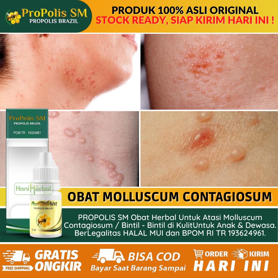 Jual OBAT MOLLUSCUM CONTAGIOSUM / MOLUSKUM KONTAGIOSUM / BINTIL BINTIL DI KULIT / BINTIK BINTIK ...