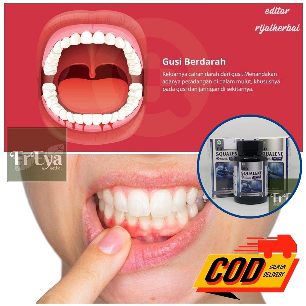 Obat Infeksi Gusi - Perumperindo.co.id