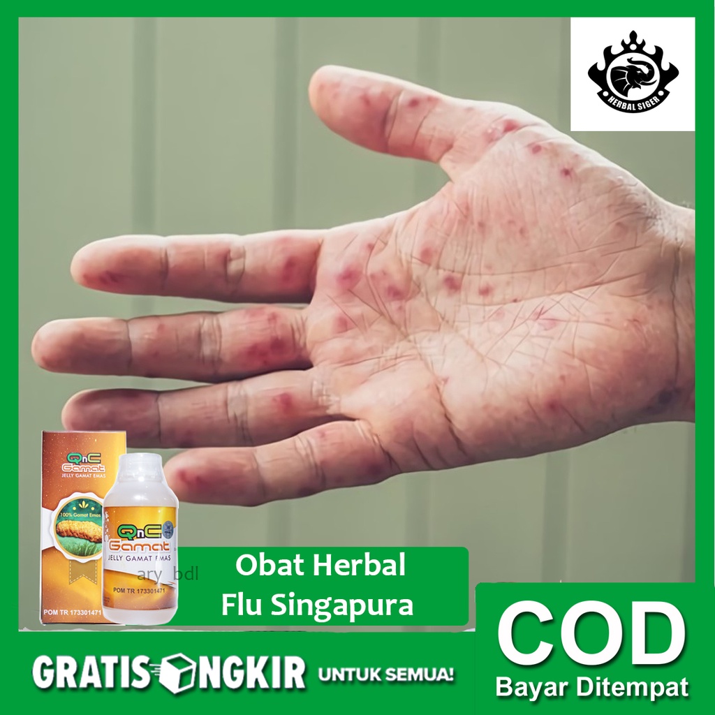 Jual Obat Herbal Flu Singapura, Penyakit Tangan, Kaki, dan Mulut, Ruam ...