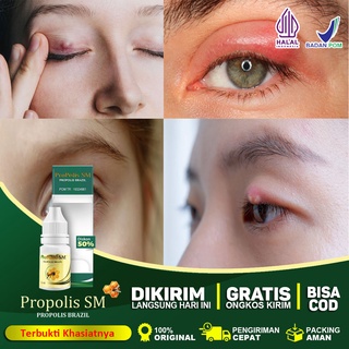 Jual Obat Mata Bintitan Timbilan Mata Timbilan Bernanah Mata Kalazion ...
